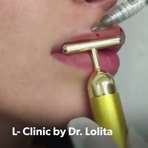 Lip augmentation procedure _____ #lipenhancemet #lip #lips #lipaugmentation #fulllips #poutylips #filler #fillers #dermalfillers #dermalfiller #botox #arstheticmedicine #doctorsinbeirut #beirutdoctors #aestheticprocedures #drlolita | L-Clinic by Dr. Lolita