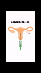 6K views · 20 reactions | IUI: The Shortcut to Baby-Making! " ...