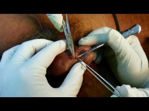 MEATOTOMY MADE EASY AND SIMPLE with Maiti's grooved dilator