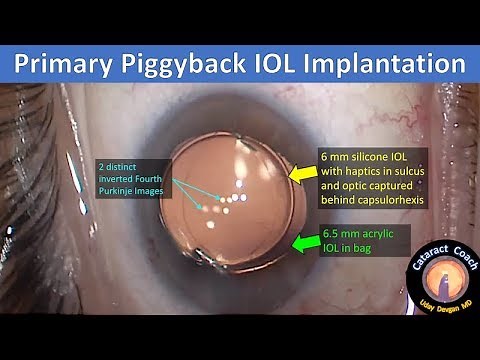 primary piggyback IOL implantation at time of cataract surgery