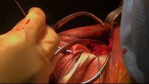 Acromioclavicular Joint Reconstruction Utilizing a Suture Cerclage Technique