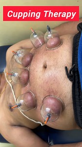 Best Cupping Therapy Treatment in kolkata @PT.Anindya ​ #backpainrelief #backpain #fbreelsvideo #fbreelsfypシ゚ #physiotherapy #chiropractic #leglengthdiscrepancy #painawaysolution #doctor #painreliefcenter #physiotherapy #bestpainreliefclinic #leglengthening #chiropractor #chiropracticadjustment #exercises #hammertherapy #chiselhammertreatment #Dr.Anindyasamanta #cupping #cuppingtherapy #cuppingmassage #cuppingtherapy #kolkata #durgapur #asansol #malda #siliguri | PAIN Away Solution